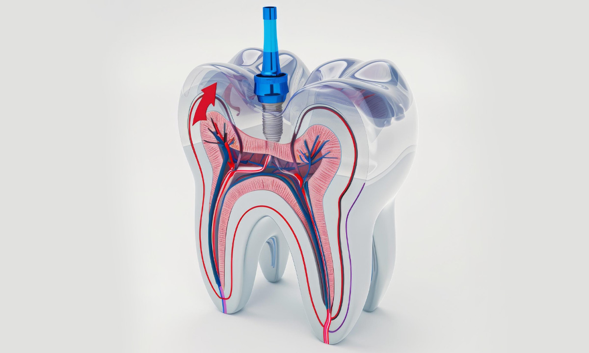 What Is the Success Rate Of Root Canal Therapy? | Desert Lake Family ...