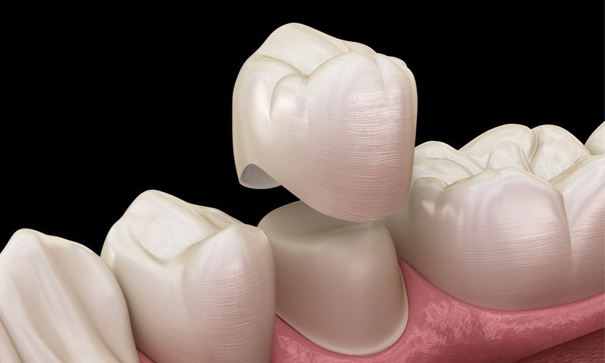 CEREC Crown vs Traditional Crown: Which Is Better? | Desert Lake Family ...